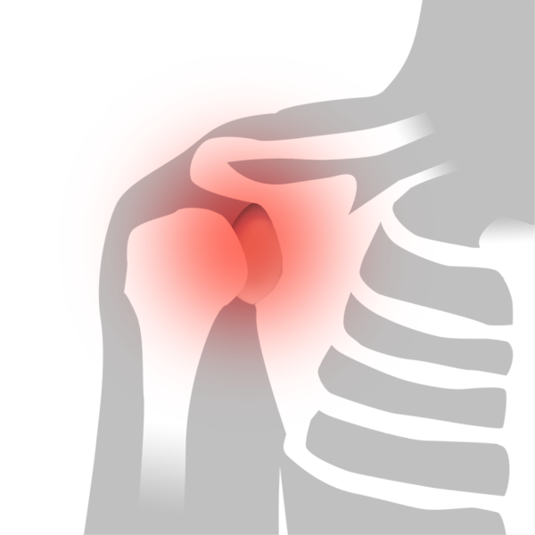 Ont i Axeln, Smärta i Axeln - Skadeguiden | REHABgrossissten