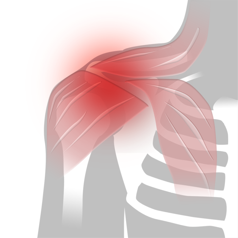 Ont i Axeln, Smärta i Axeln - Skadeguiden | REHABgrossissten